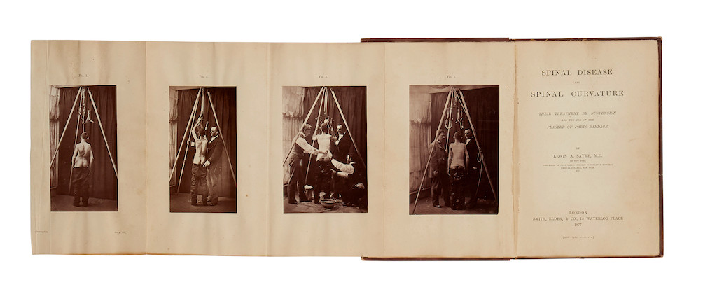 Bonhams : SAYRE, LEWIS A. 1820-1900. SPINAL DISEASE AND SPINAL ...