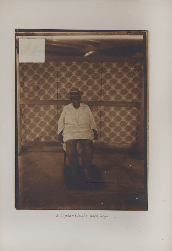 Bonhams : ELEPHANTIASIS. Elephantiasis both legs. c.1890.