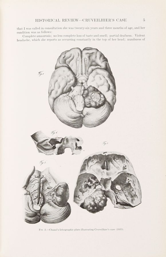 Bonhams : CUSHING, HARVEY. 1869-1939. Tumors of the Nervus Acusticus ...