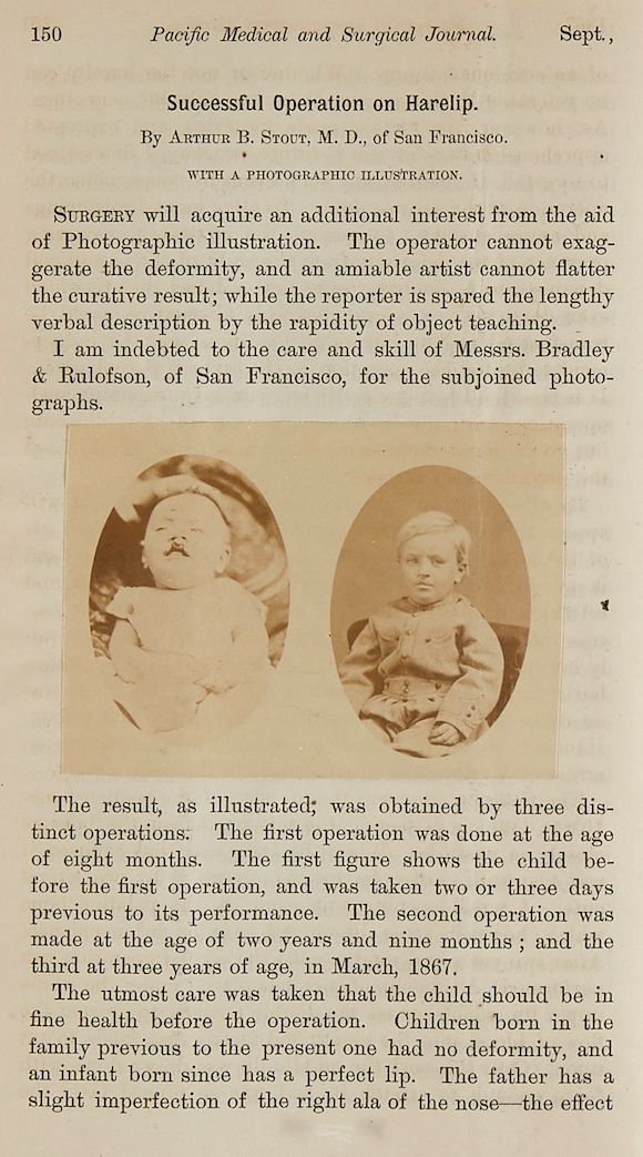 Bonhams : STOUT, ARTHUR B. 1814-1898. "Successful Operation on Harelip ...