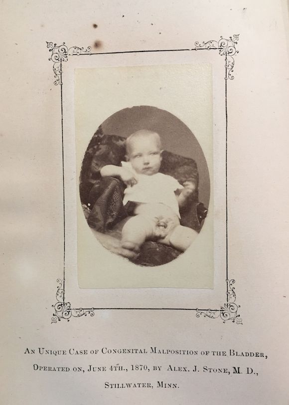 Bonhams : STONE, ALEXANDER J. 1846-1910. "A Unique Case of Congenital ...
