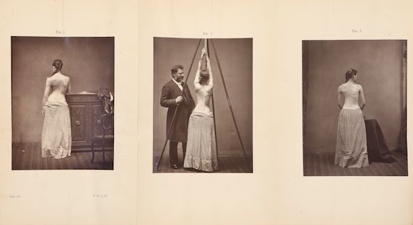 Bonhams : SAYRE, LEWIS. 1820-1900. Spinal Disease and Spinal Curvature ...